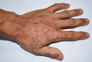 Understanding Scabies: Symptoms, Causes, Diagnosis, and Treatment ...